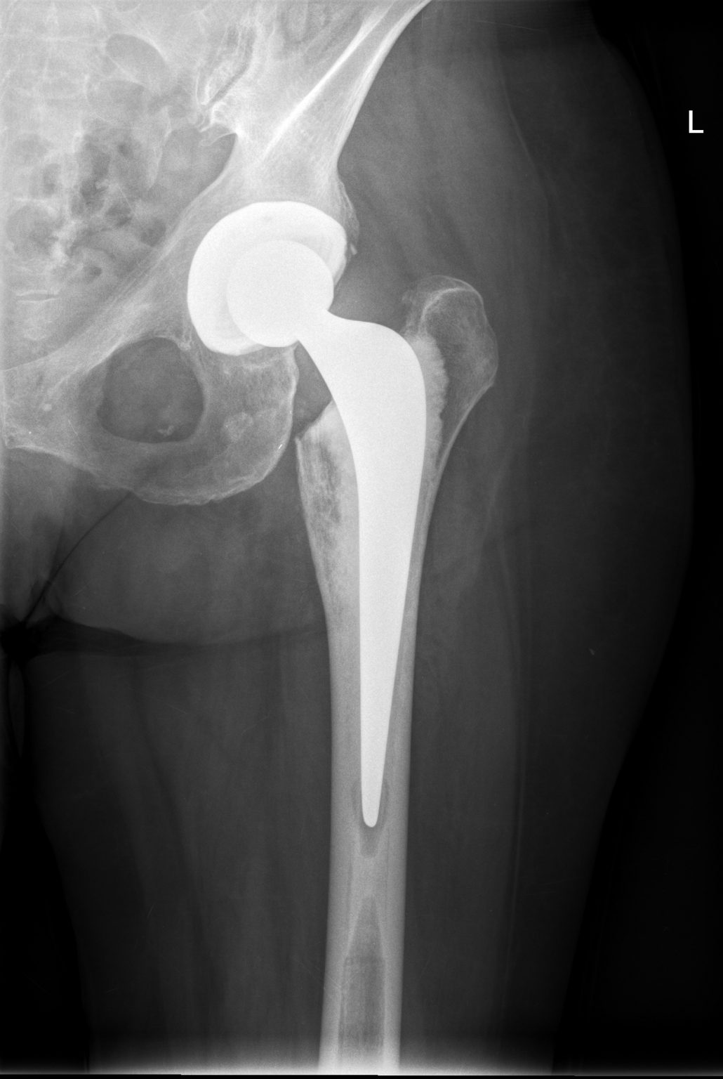Hip Treatments - Mr J Agustin Soler, FRCS (Tr&Orth)